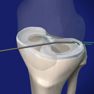 Meniscus Repair – Osteocare