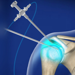 Shoulder – Osteocare